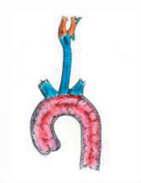 Coding Corner: IR Roadblocks